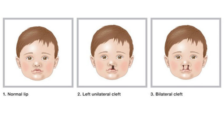 Facial Trauma| Deformity Correction by Top Maxillofacial Surgeon in Indore