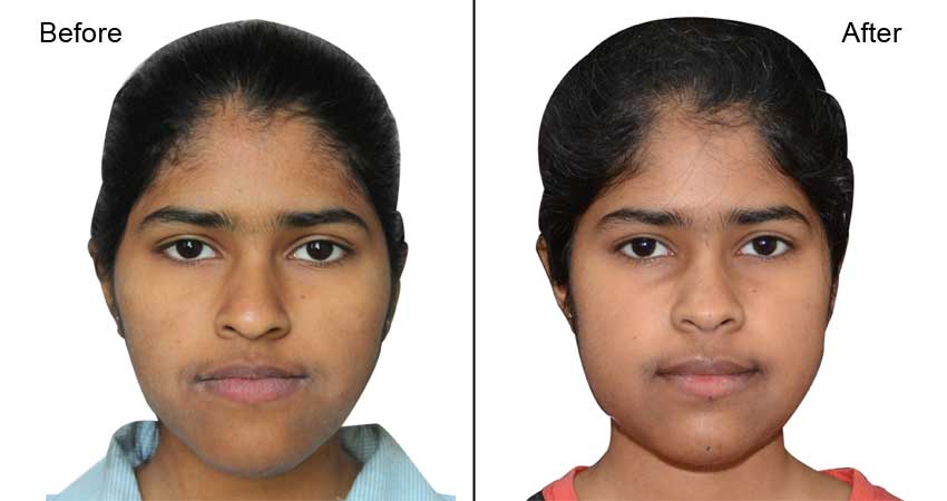 Facial Plastic Surgeon in Indore|Maxillofacial Surgeon|Dr Anurag Bhargava